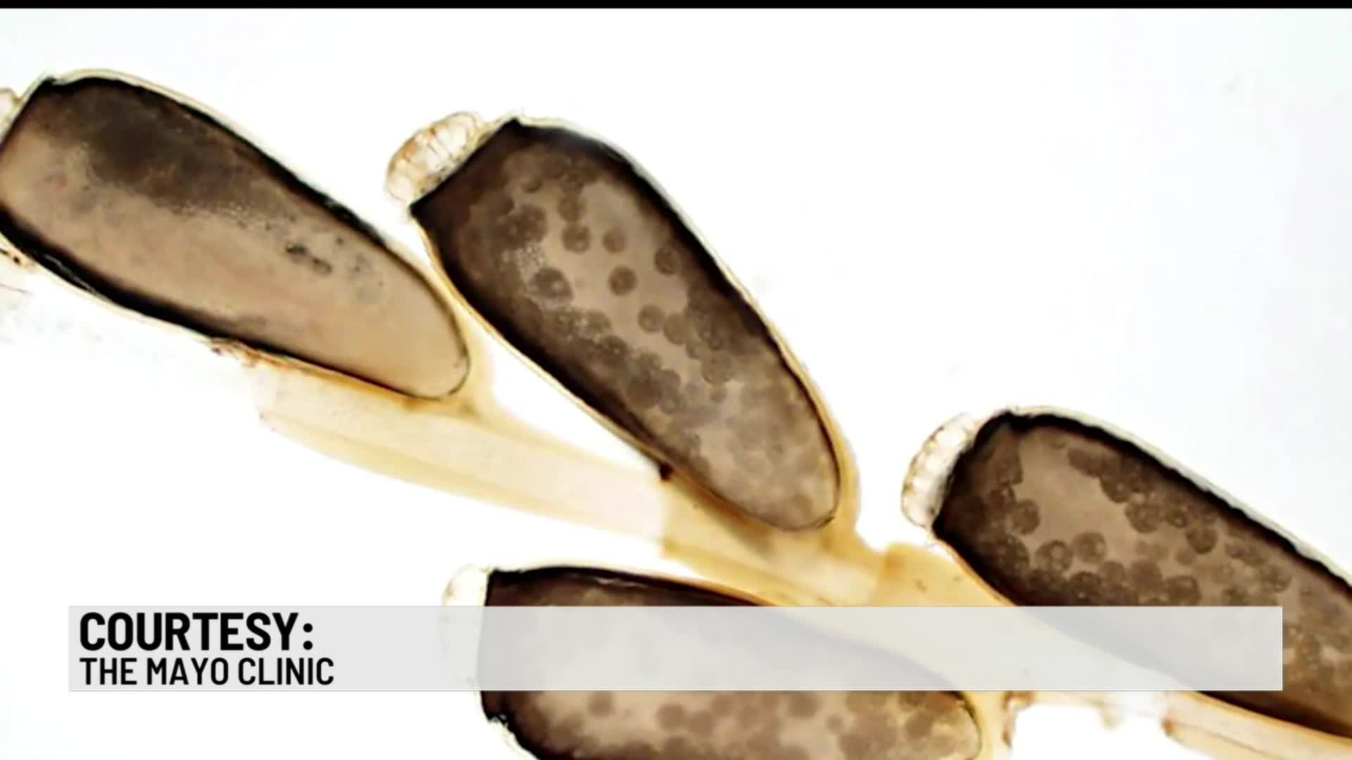 How lice spreads, and how to treat infestations – WYTV